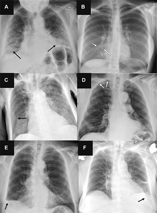 Radiologists Outperformed AI in Identifying Lung Diseases on Chest X ...