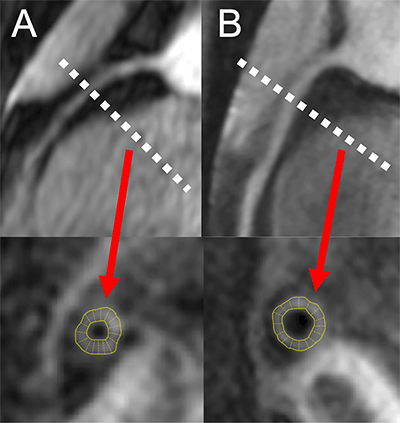 Coronary Disease in Asymptomatic HIV | RSNA