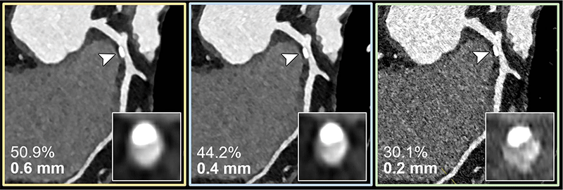 Photon-Counting CT Improves Coronary Artery Disease Assessment | RSNA