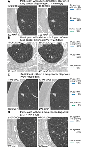 Deep Learning For Classifying Lung Nodules | RSNA