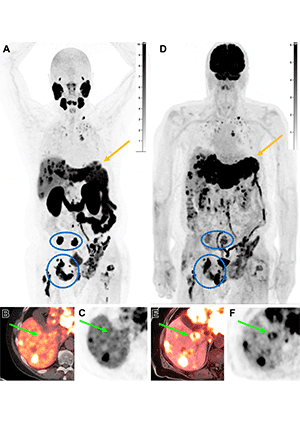 Theranostics Imaging Biomarkers for Precision Medicine | RSNA
