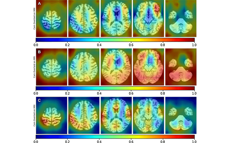Deep Learning Predicts Alzheimer's Disease Markers | RSNA