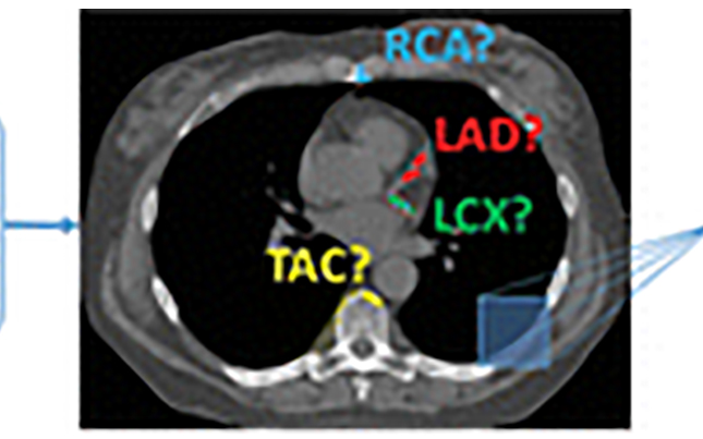 Deep Learning Algorithm Proves Effective for Automatic Coronary Artery ...