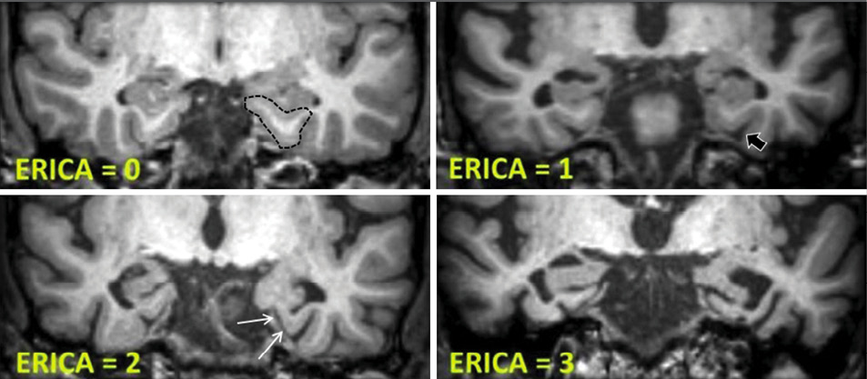 New MRI-Based Technology Shows Promise in Identifying Brain Atrophy ...