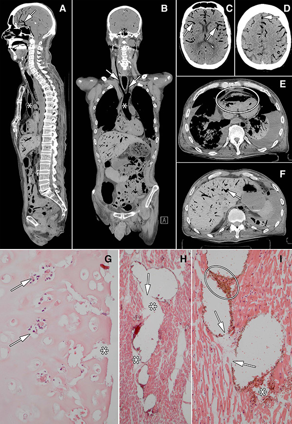 Minimally Invasive Autopsy Improves Postmortem Diagnoses | RSNA