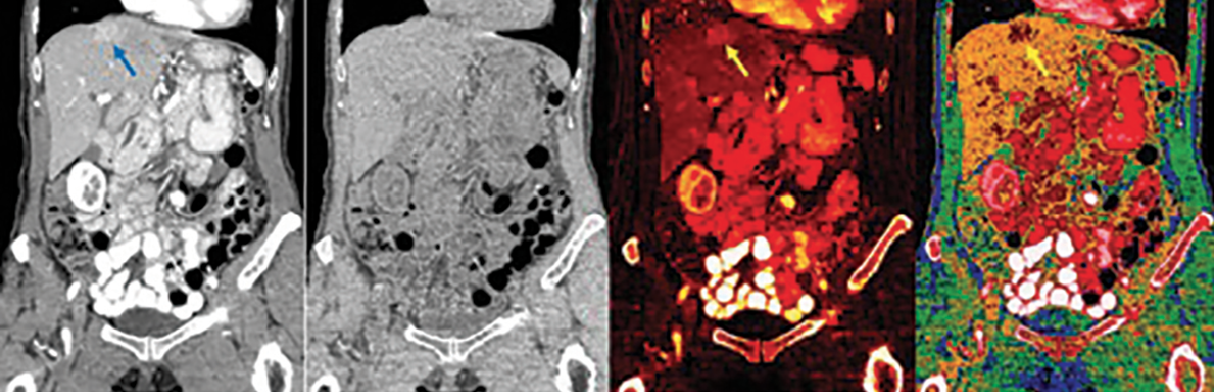 Look Ahead The Future of Abdominal Imaging | RSNA