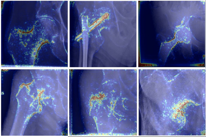 Automating Hip Fracture Diagnosis with Deep Learning May Improve ...