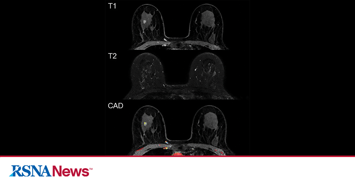 MRI For Breast Cancer Screening | RSNA