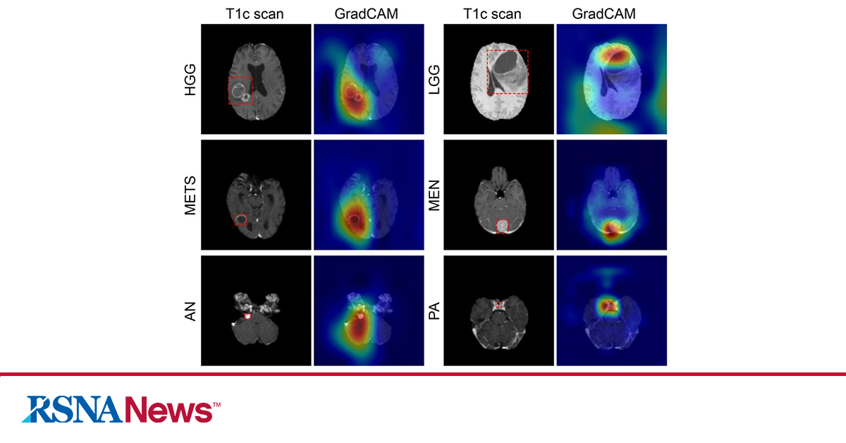 DL Model For Brain Tumors | RSNA