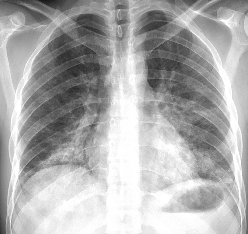 Radiology: Cardiothoracic Imaging Publishes Special Report on Vaping | RSNA