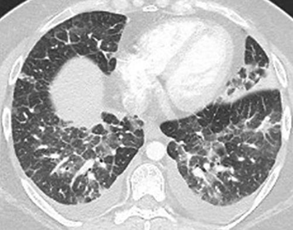Lung Injuries from Vaping Have Characteristic Patterns on CT | RSNA