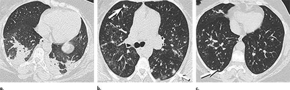 Lung Injuries from Vaping Have Characteristic Patterns on CT | RSNA