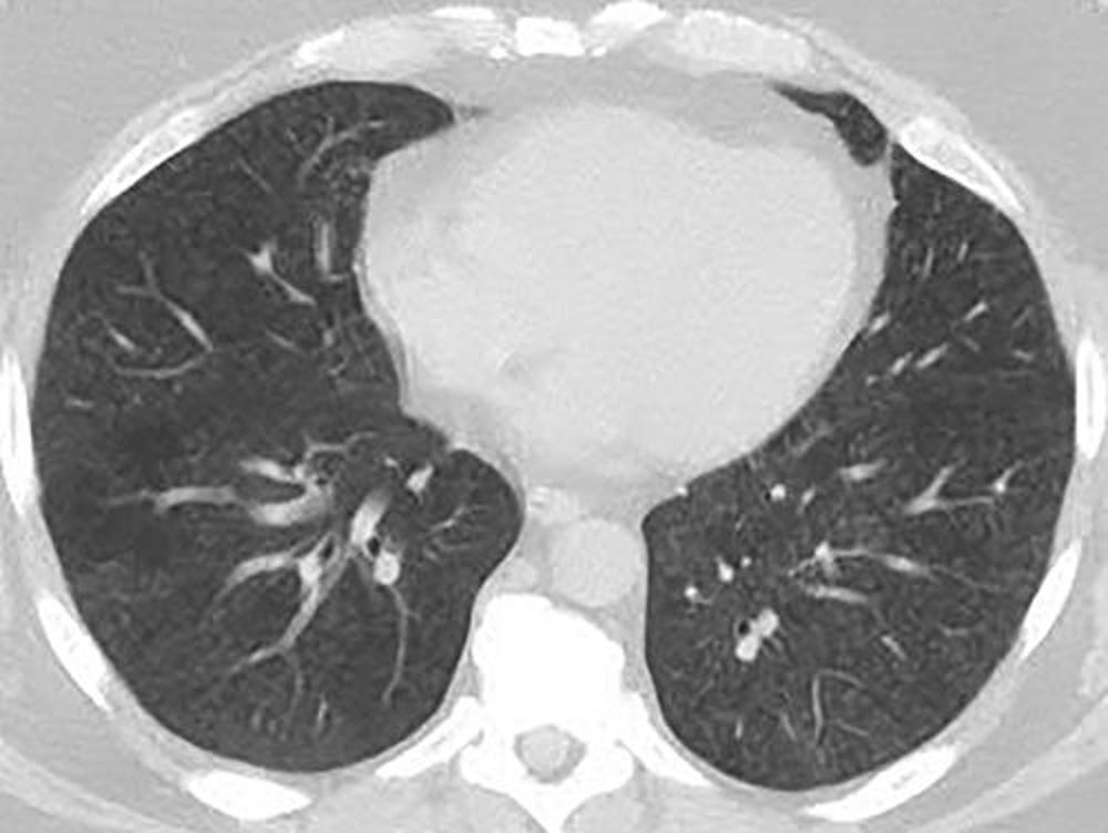 Lung Injuries from Vaping Have Characteristic Patterns on CT | RSNA