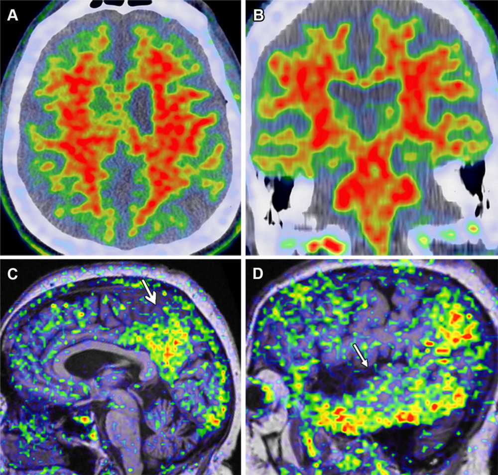 Radiologists Must Monitor Novel Alzheimer’s Treatment Side Effect | RSNA