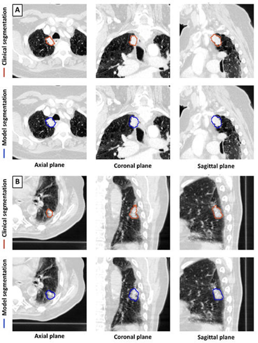Deep Learning Model Helps Detect Lung Tumors on CT | RSNA