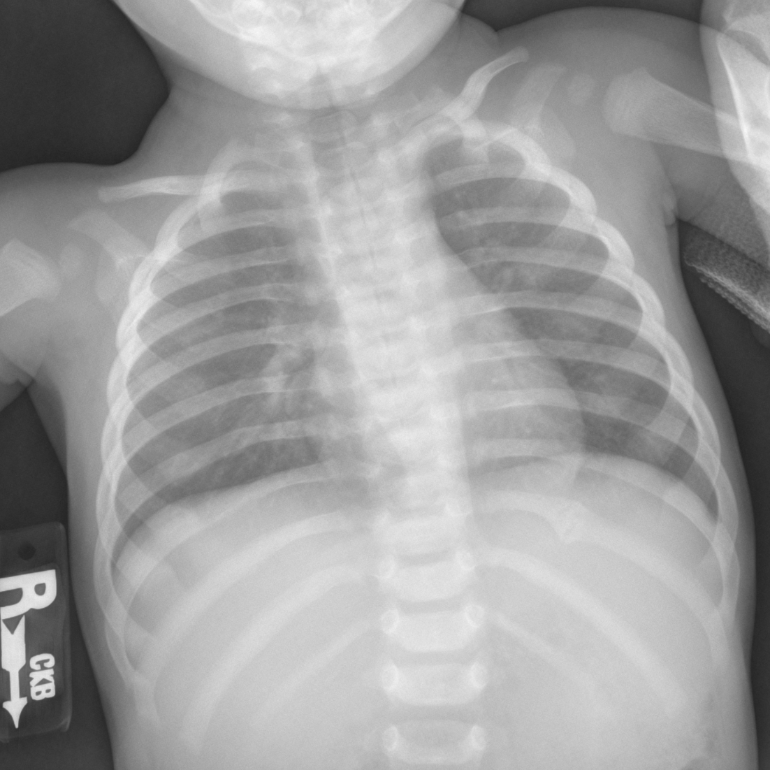 Radiology Plays Critical Role in the Diagnosis of Child Abuse